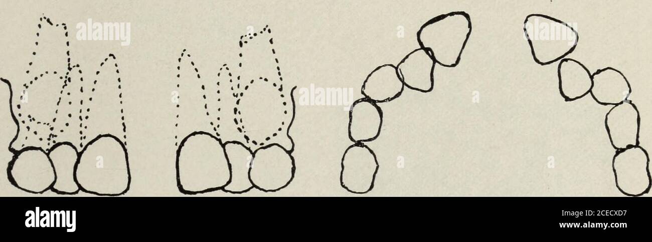 . The Dental cosmos. Impaction—narrow and short arches.. Lateral ...