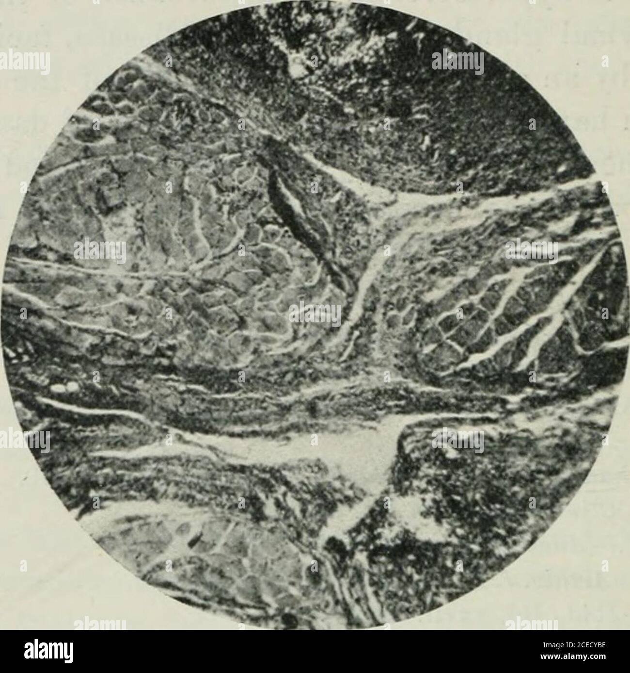 Tonsil guillotine hi-res stock photography and images - Alamy