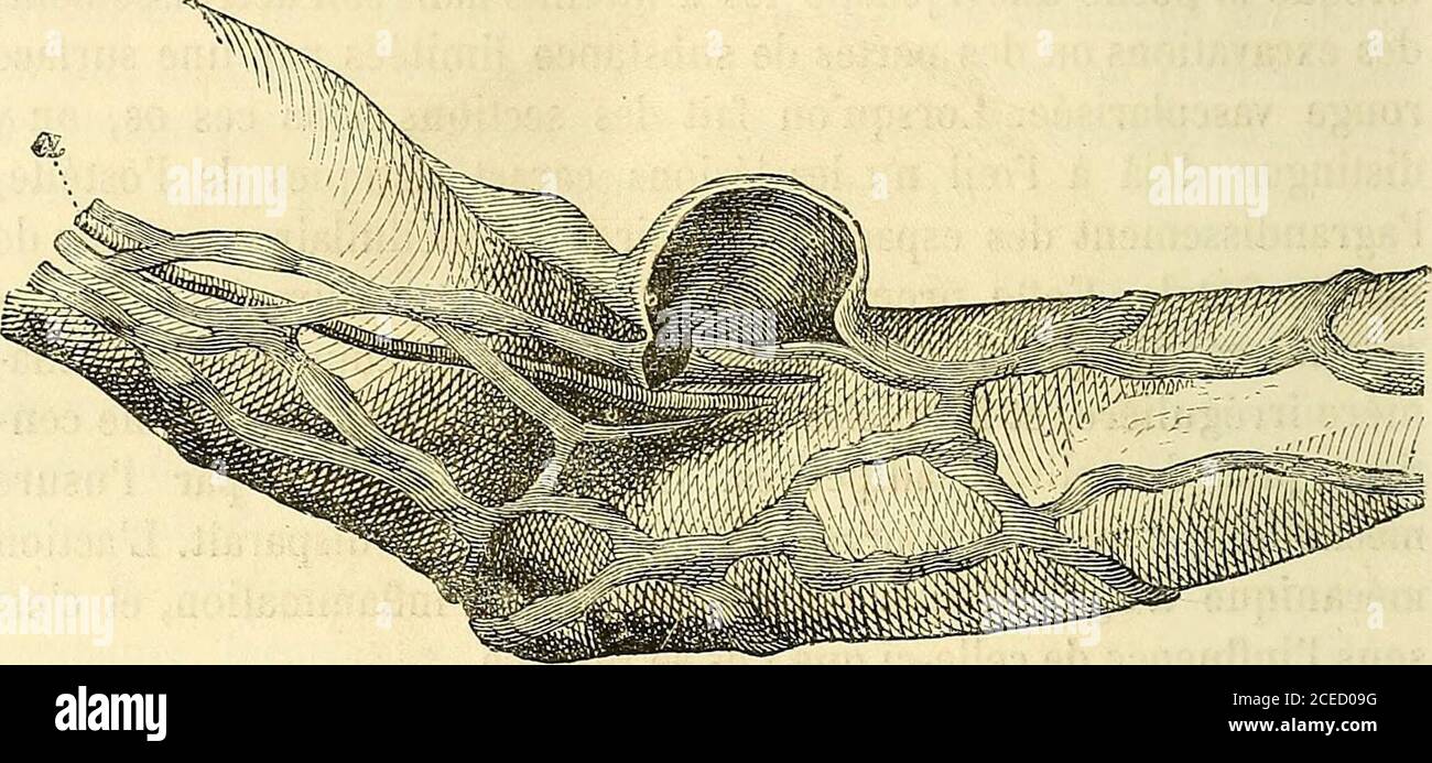 Charcot bouchard hi-res stock photography and images - Alamy