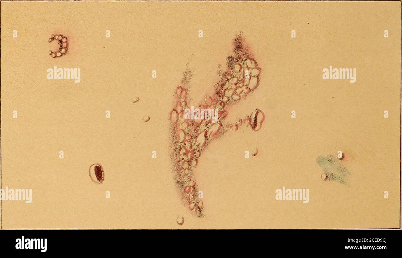 Syphilitic lichen hi-res stock photography and images - Alamy