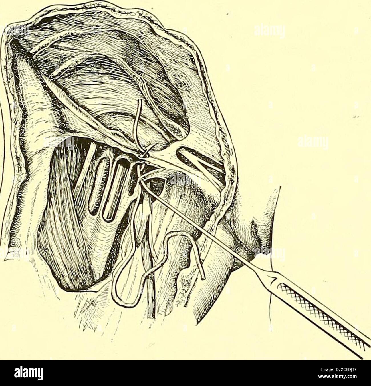 . The anatomy and surgical treatment of hernia. g the dilatedpart of ...
