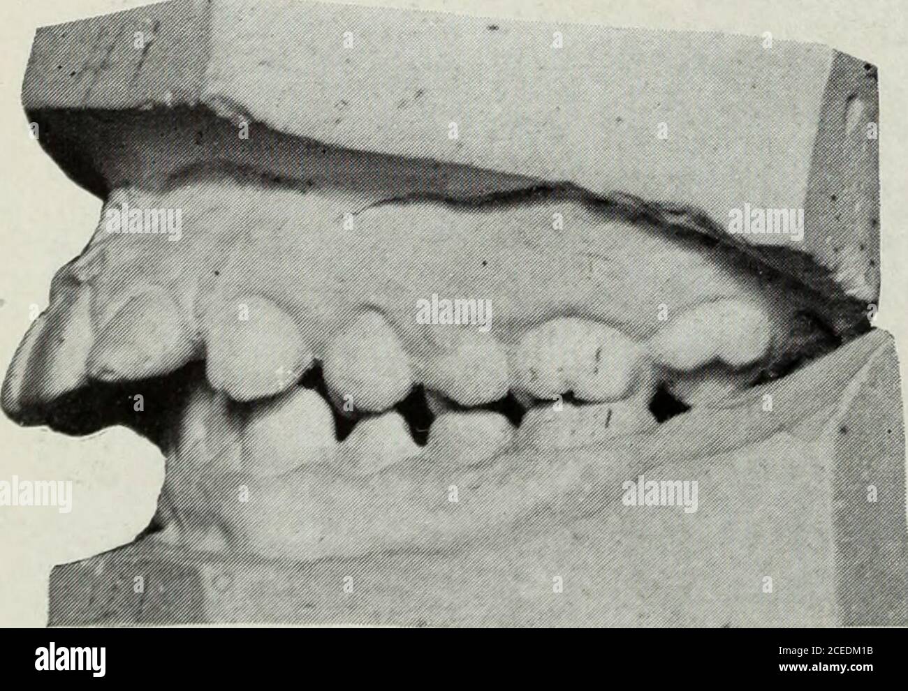 . The Dental cosmos. After treating. CASES OF CLASS II, DIVISION I. In ...