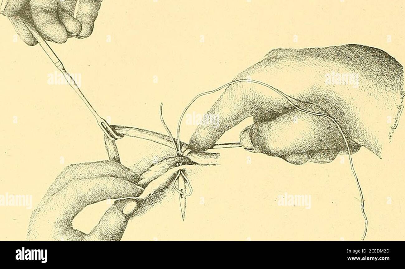 . The anatomy and surgical treatment of hernia. Fig. 30. Fig. 29. Fig ...