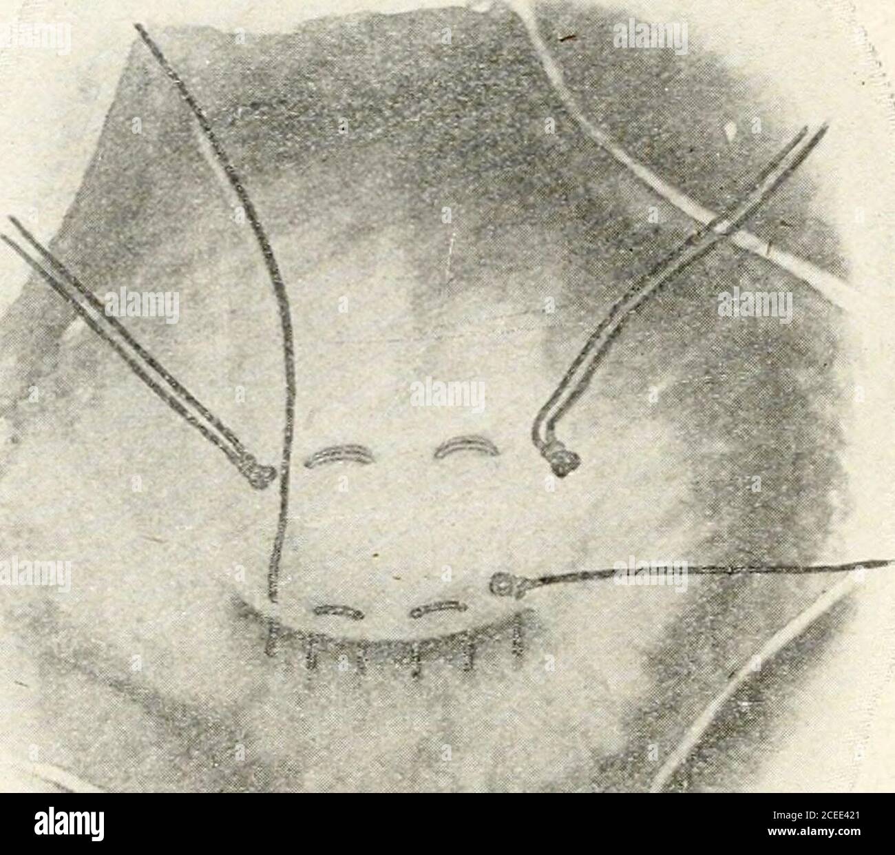 . Plexus. Fig. 9. Umbilical hernia. 1st suture in position. tinuous ...