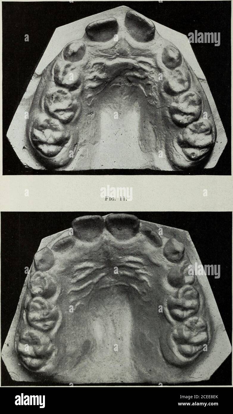 . The Dental cosmos. -0. S. Monson. ous molars show signs of absorption ...