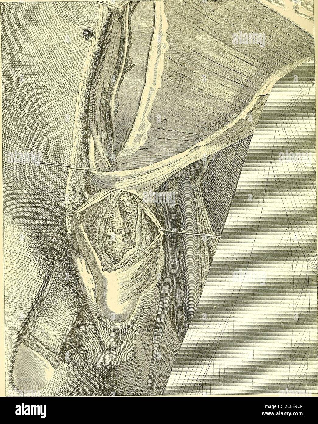 . The anatomy and surgical treatment of hernia. y of Le Dran, which is ...