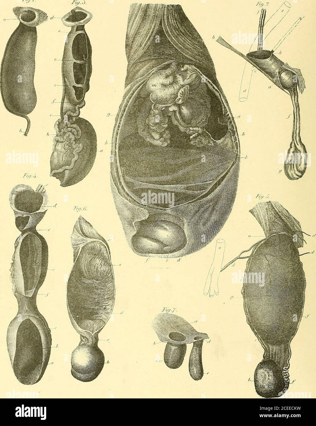 Umbilical hernia anatomy hi-res stock photography and images - Alamy