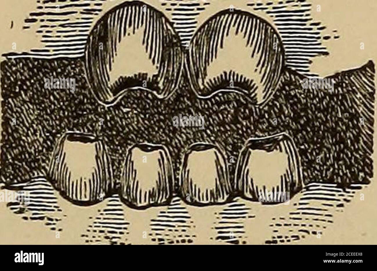 Hutchinson Teeth What Are Hutchinson Teeth?