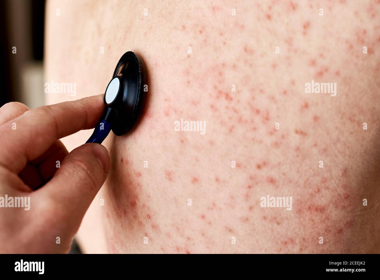 Allergic rash on the skin. Woman with dermatology problem on back skin ...