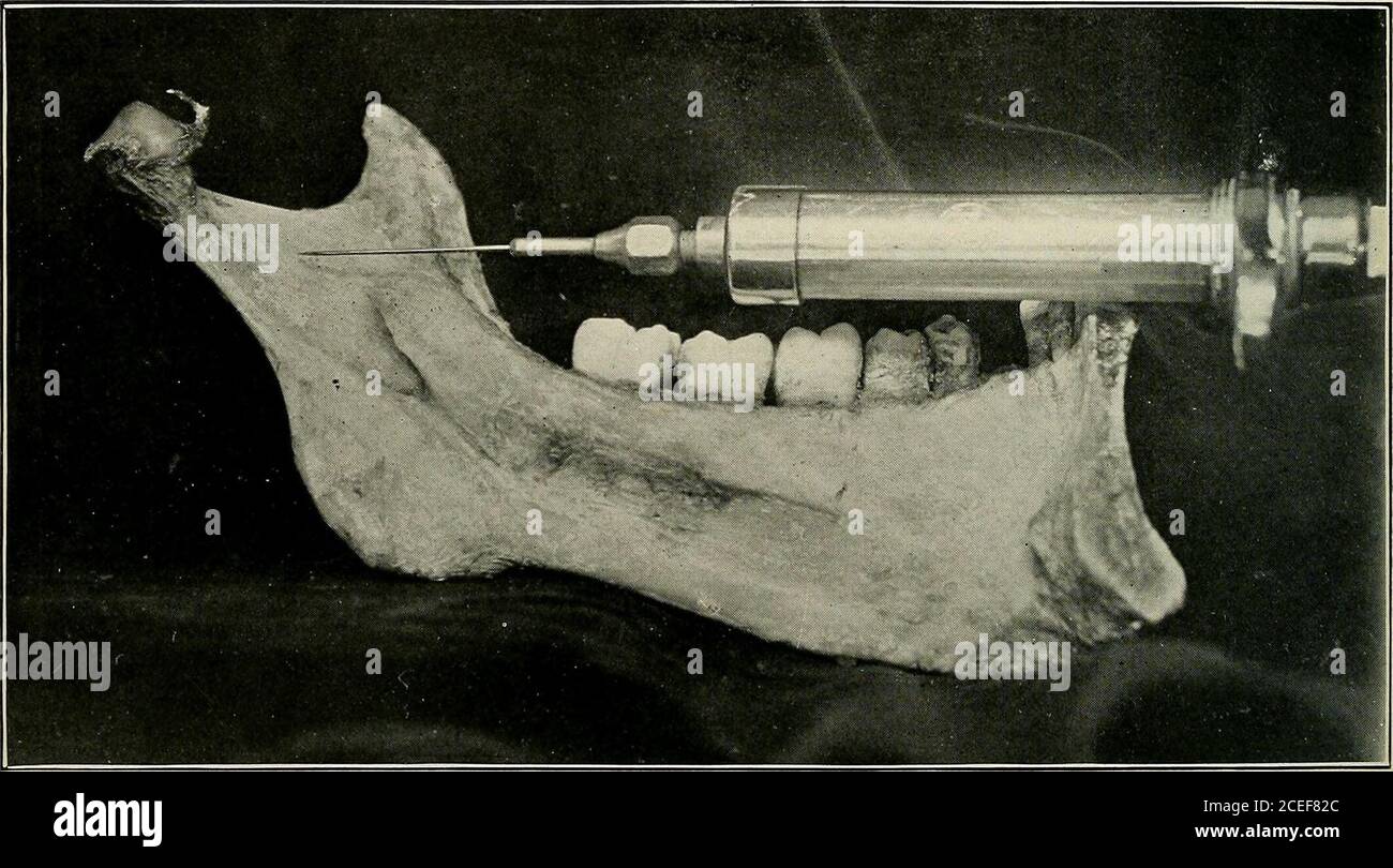 . Oral anaesthesia; local anaesthesia in the oral cavity, technique and ...