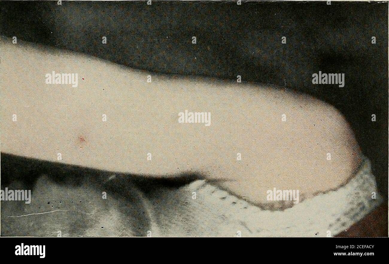 Wassermann test hi-res stock photography and images - Alamy