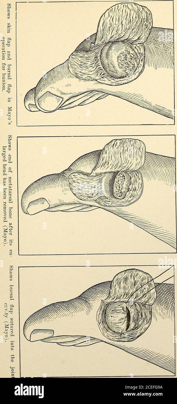 Wedge defect hi-res stock photography and images - Alamy