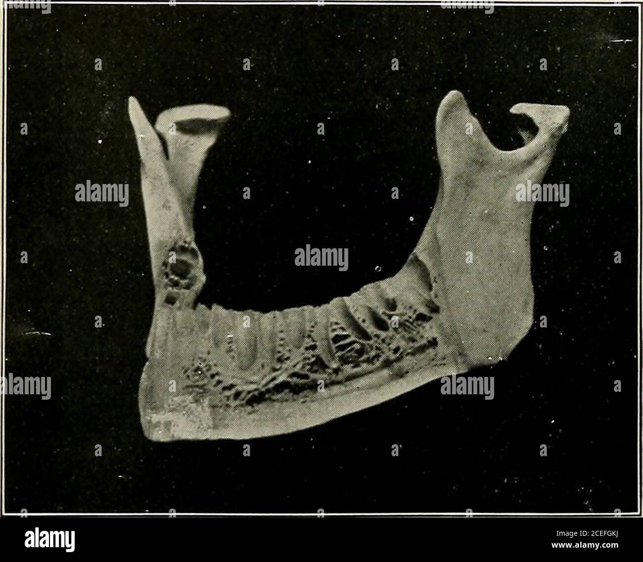 Mandibular foramen hi-res stock photography and images - Alamy