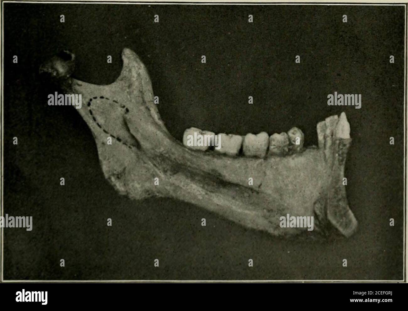 Mandibular foramen hi-res stock photography and images - Alamy