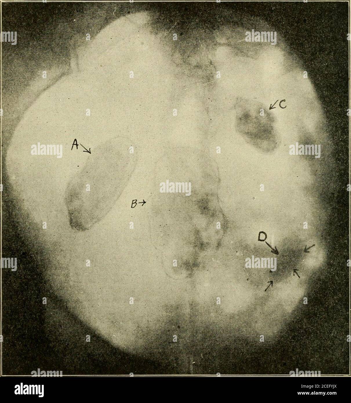 Pelvic floor surgery hi-res stock photography and images - Alamy