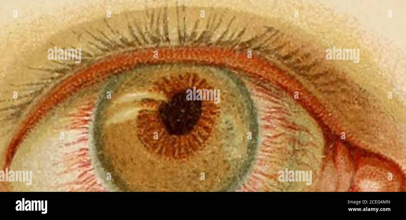 Pannus Human Eye