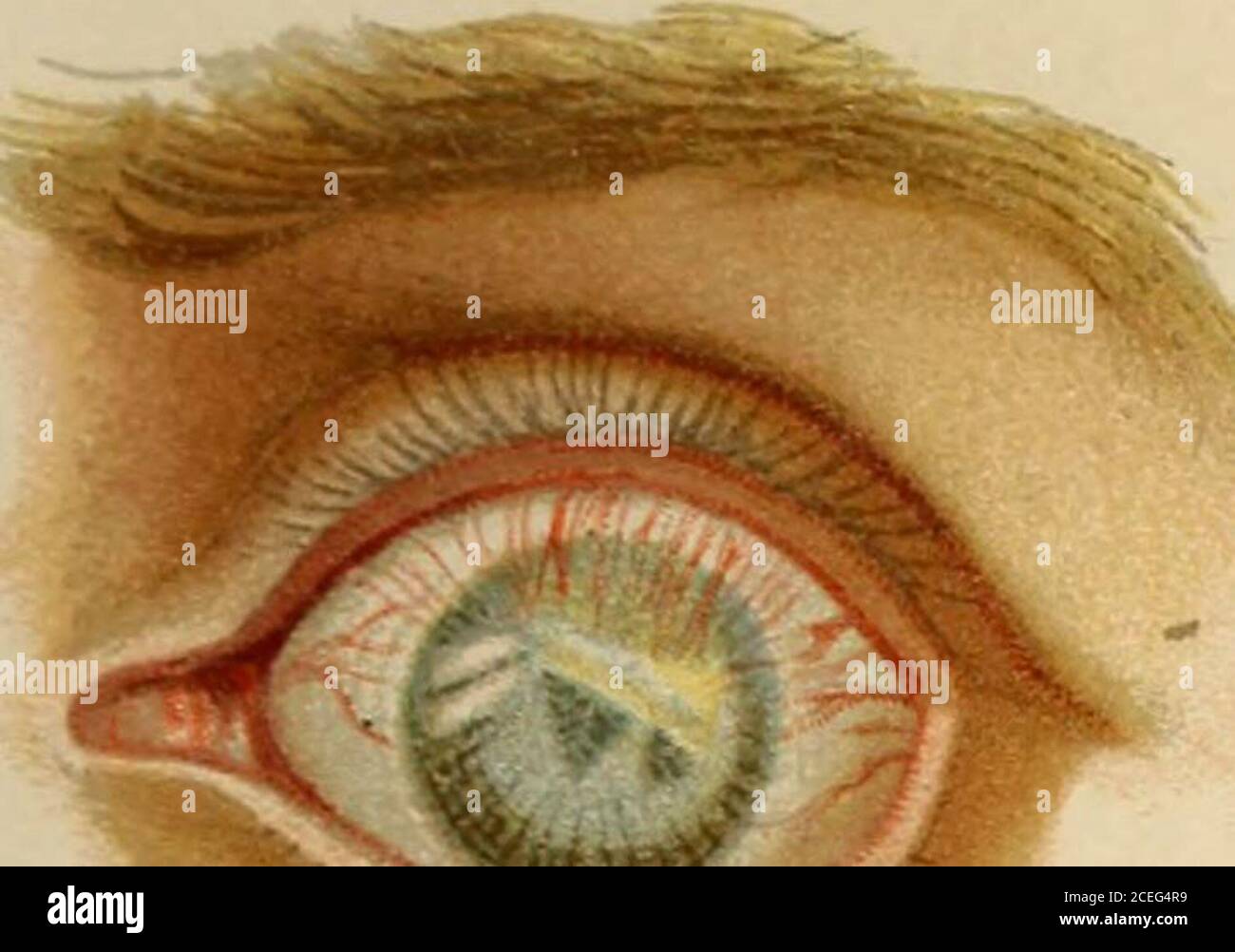 Pannus Human Eye