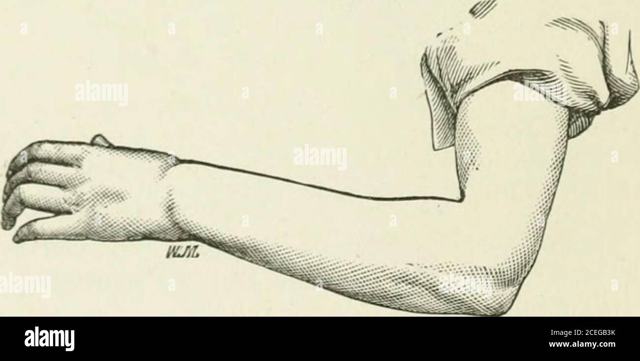 Discharge splint hi-res stock photography and images - Alamy