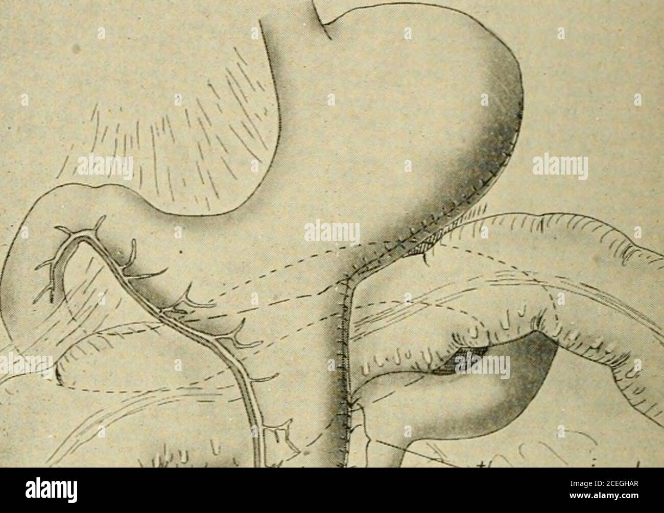 Ulcer Base High Resolution Stock Photography and Images - Alamy