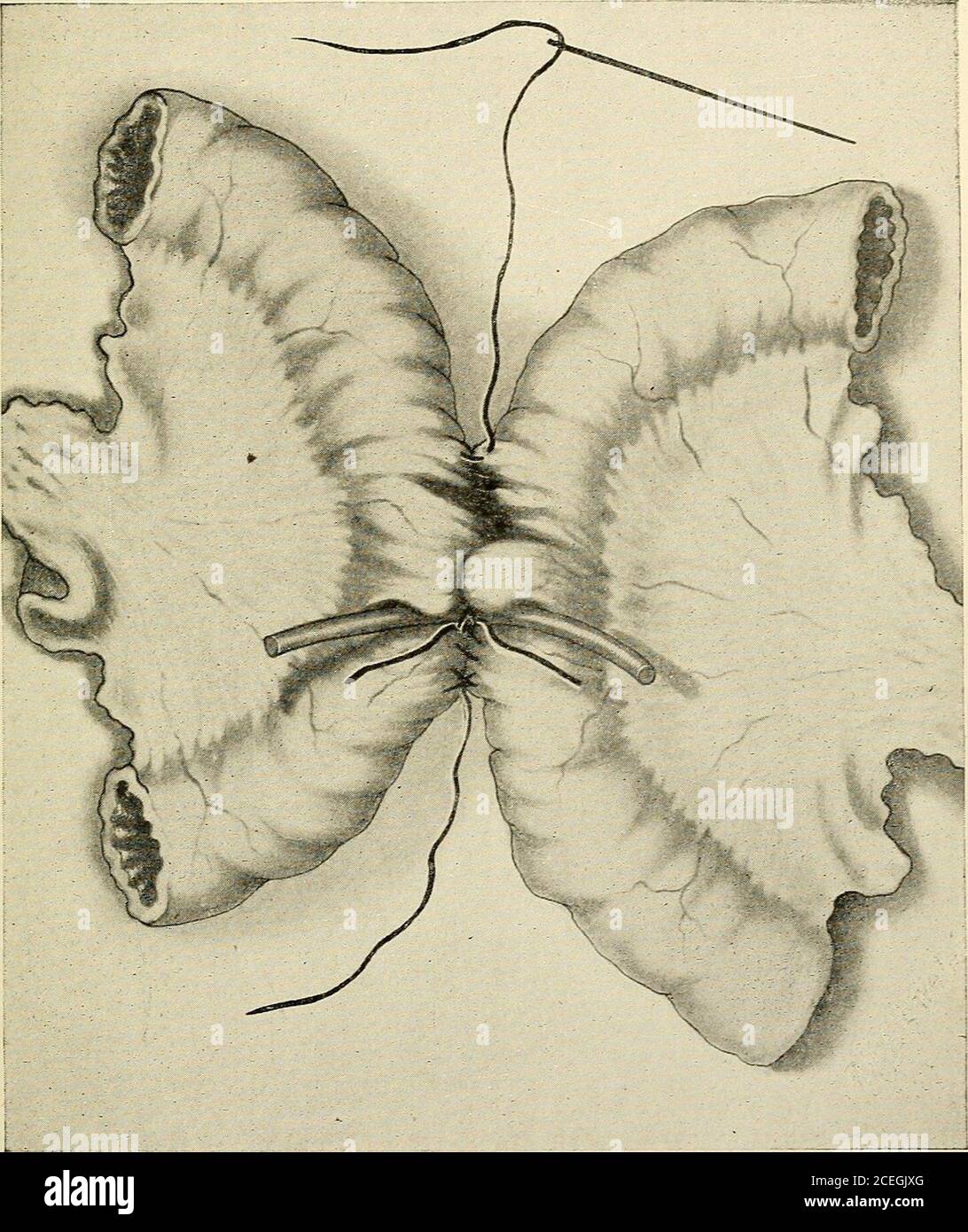 . A new manual of surgery, civil and military. Enterostomy with McGraw ...