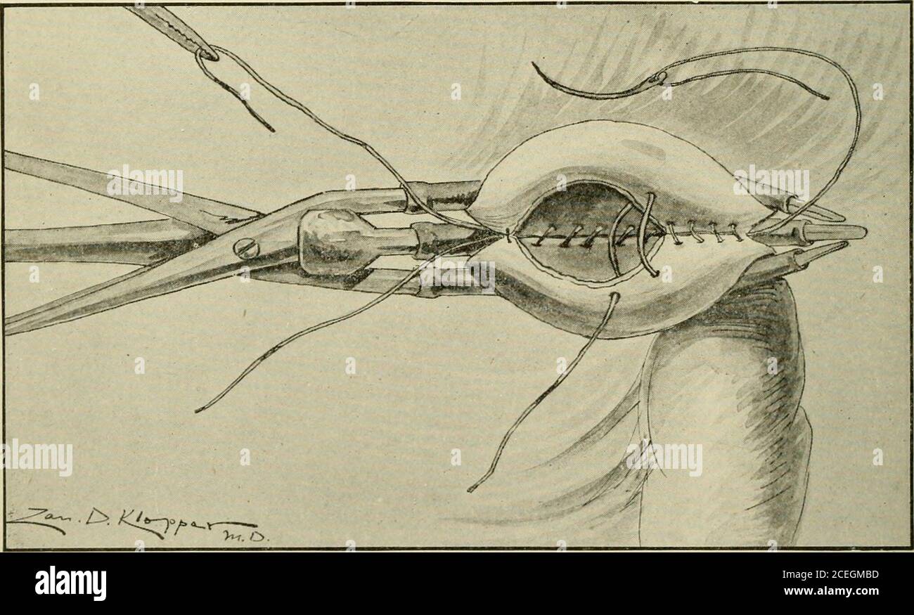 Intestinalwall hi-res stock photography and images - Alamy