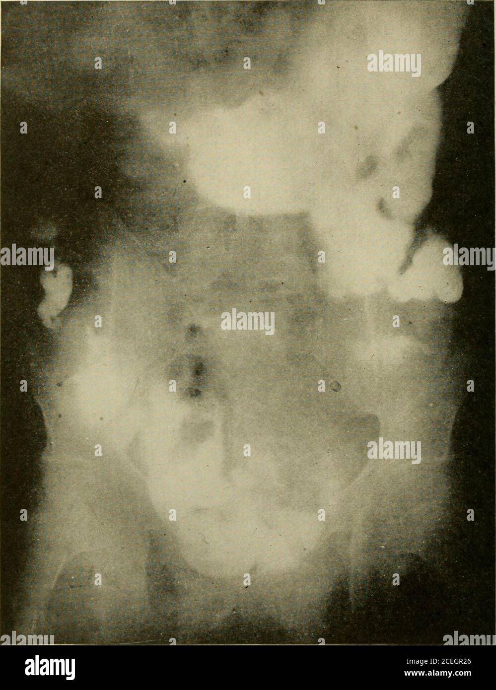 . A new manual of surgery, civil and military. X-Eay op Gastric Ulcer ...