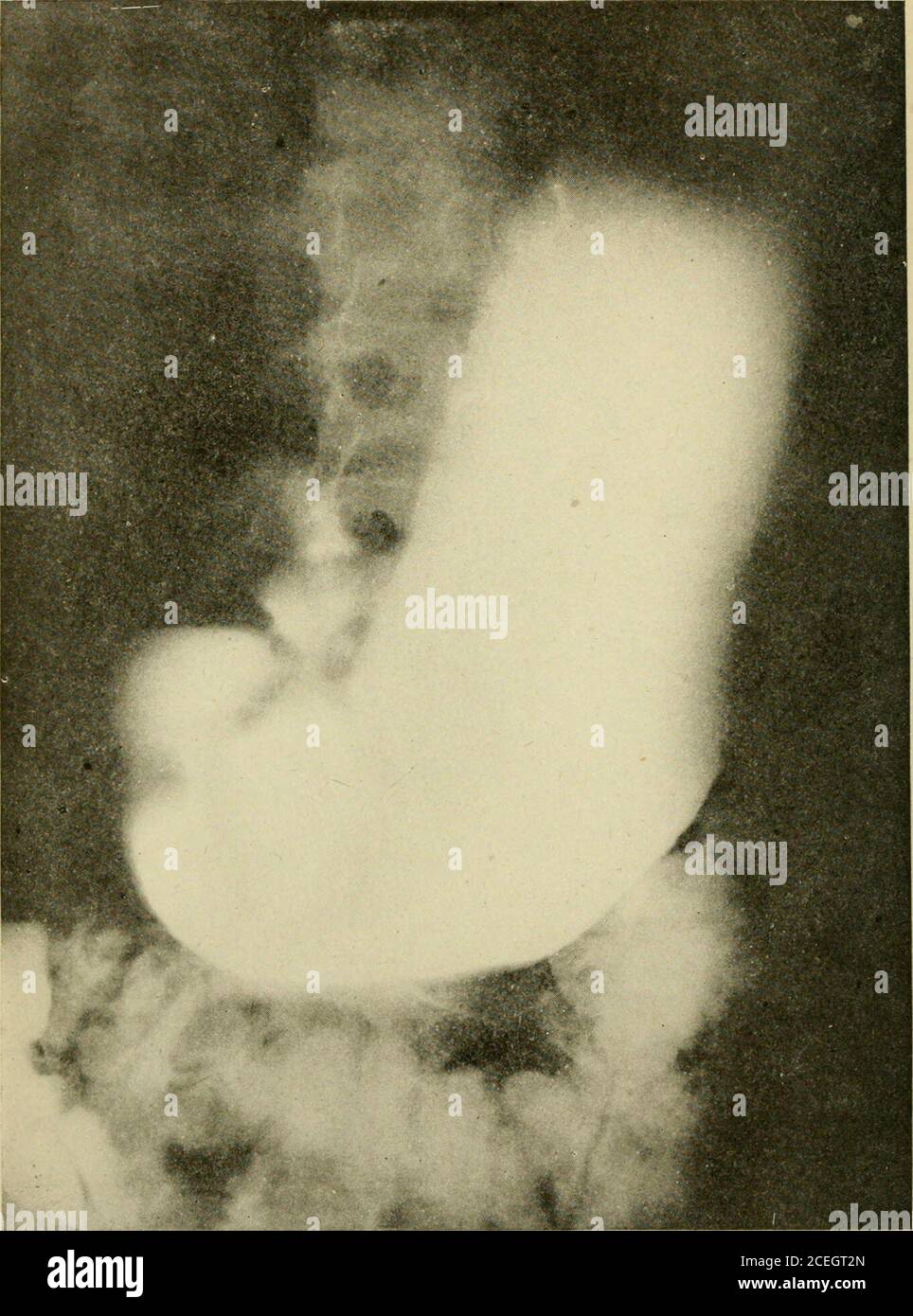 . A new manual of surgery, civil and military. X-Eay of Dilated Stomach ...