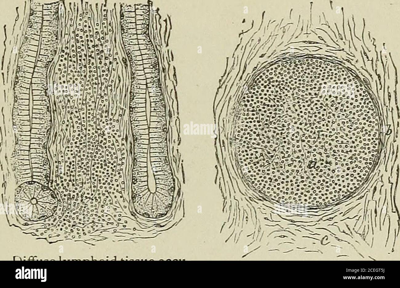 Lymphatic Nodules High Resolution Stock Photography and Images - Alamy