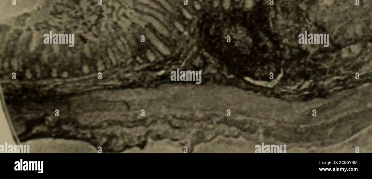 . Medical diseases of infancy and childhood. Acute follicular enteritis ...