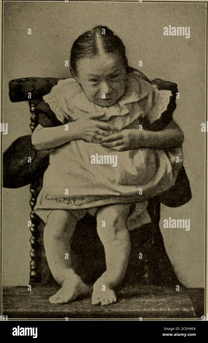 . Medical diseases of infancy and childhood. Congenital cretinism. The ...