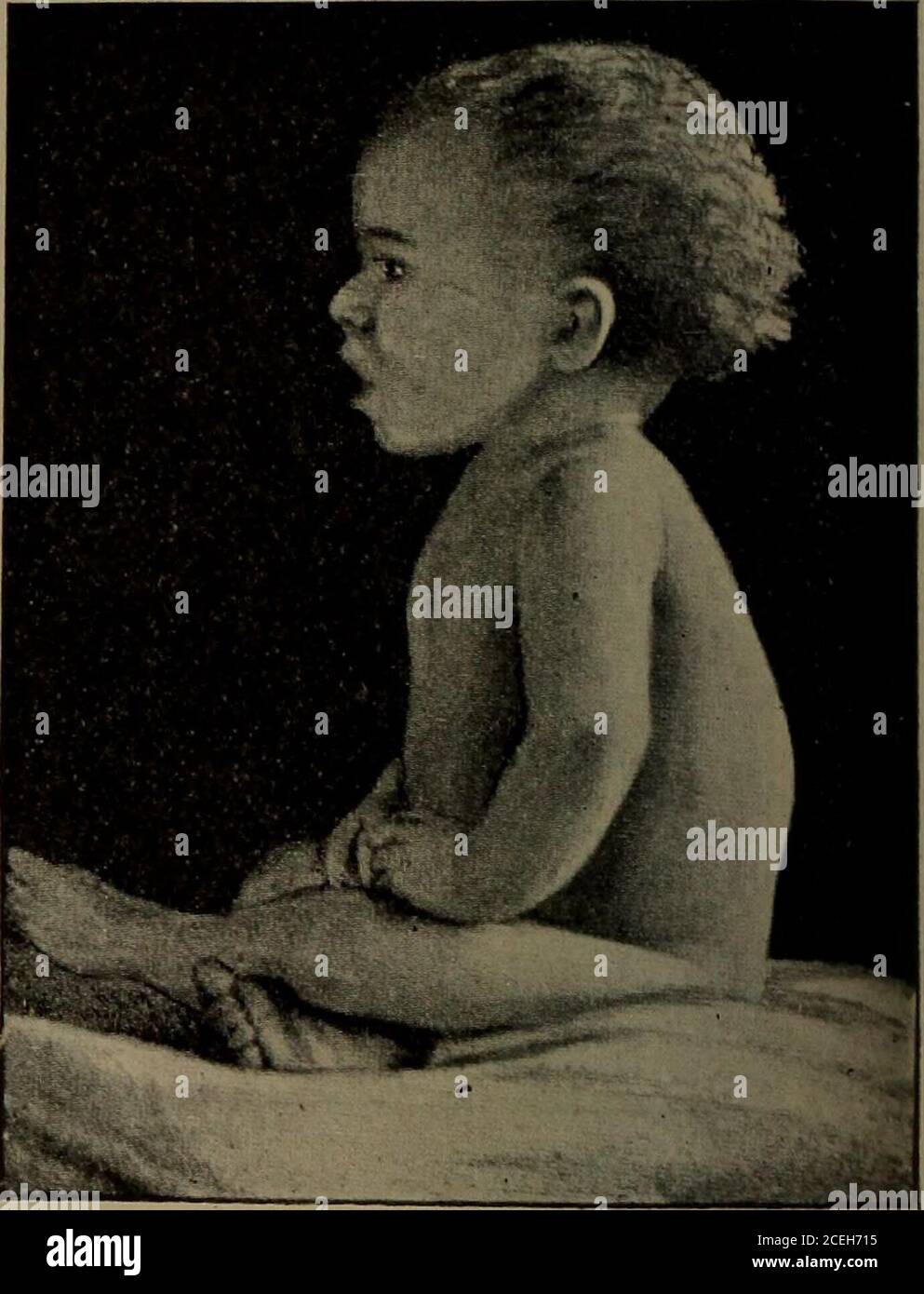 Rickets child hi-res stock photography and images - Alamy