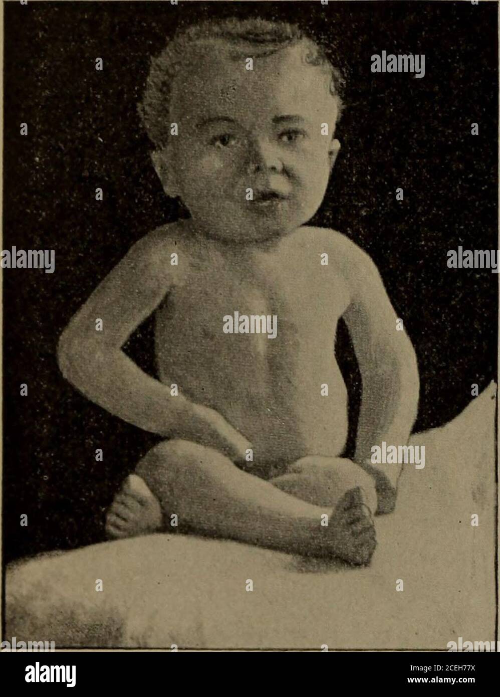 Rickets symptoms hi-res stock photography and images - Alamy
