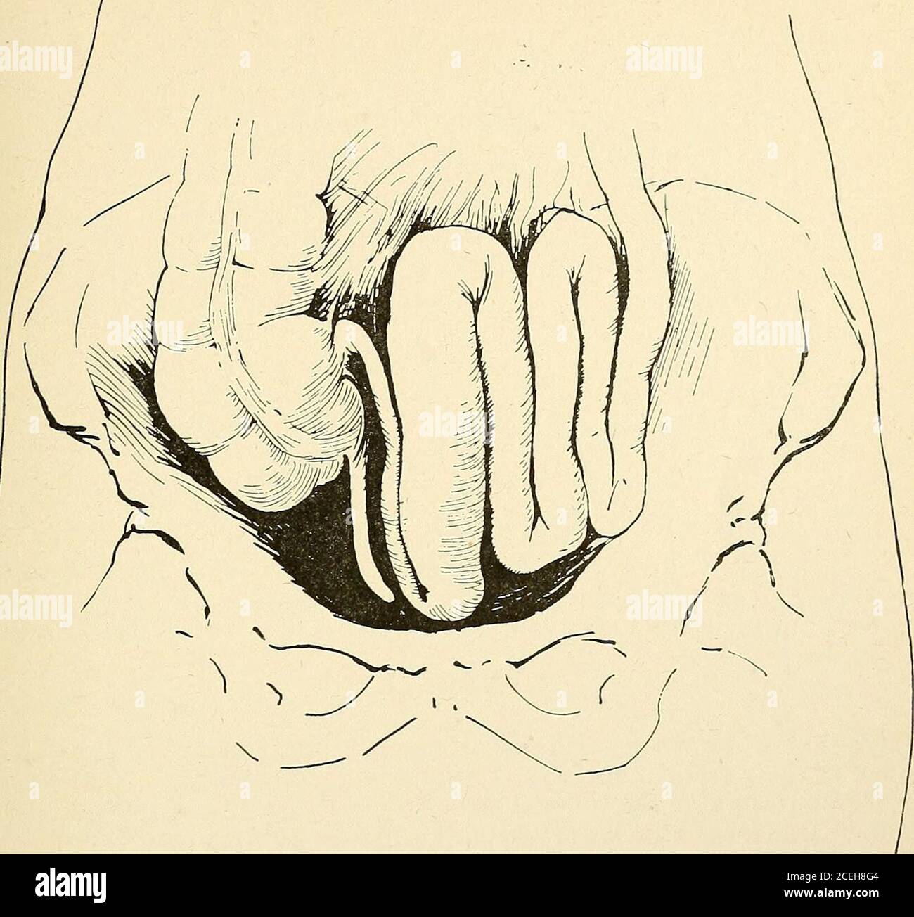 . A new manual of surgery, civil and military. f theomphalomesenteric ...