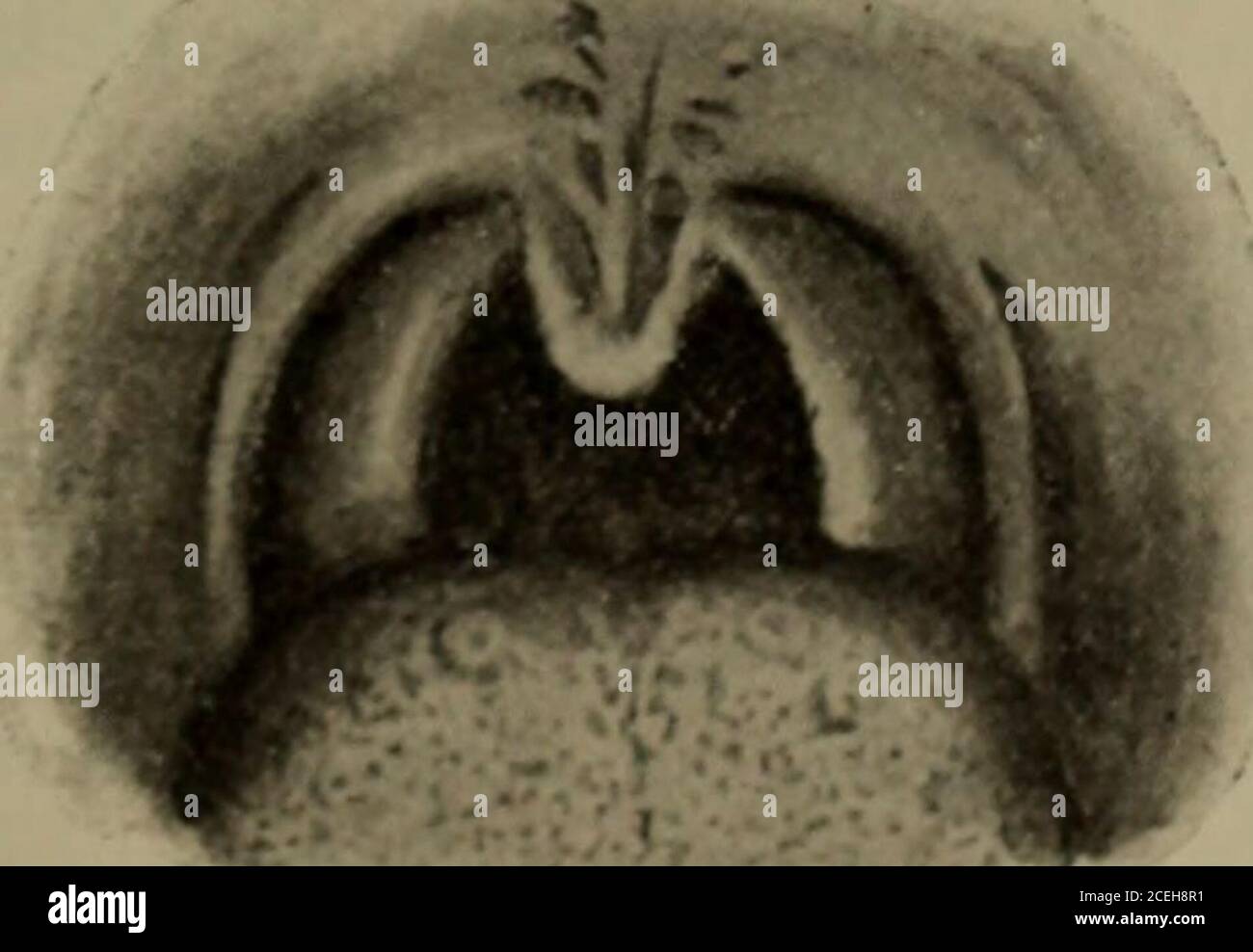 18 hours after infection hi-res stock photography and images - Alamy