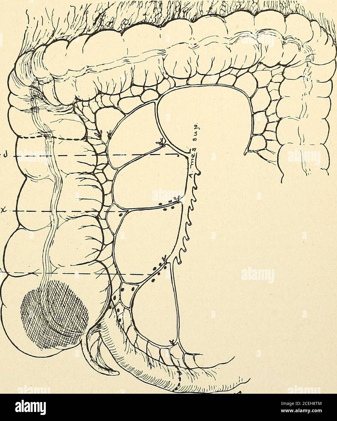 Fistula abdomen hi-res stock photography and images - Alamy