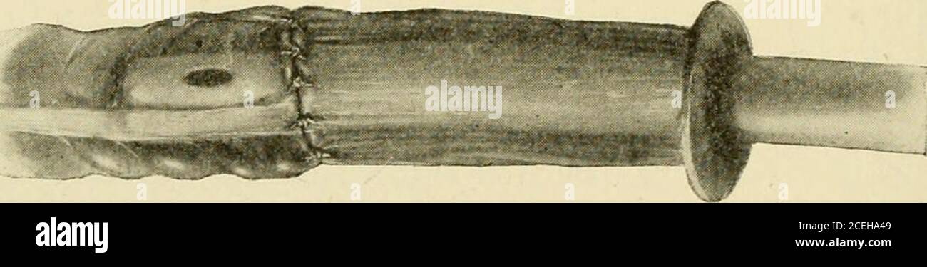 . A new manual of surgery, civil and military. 1. Showing Tube ...