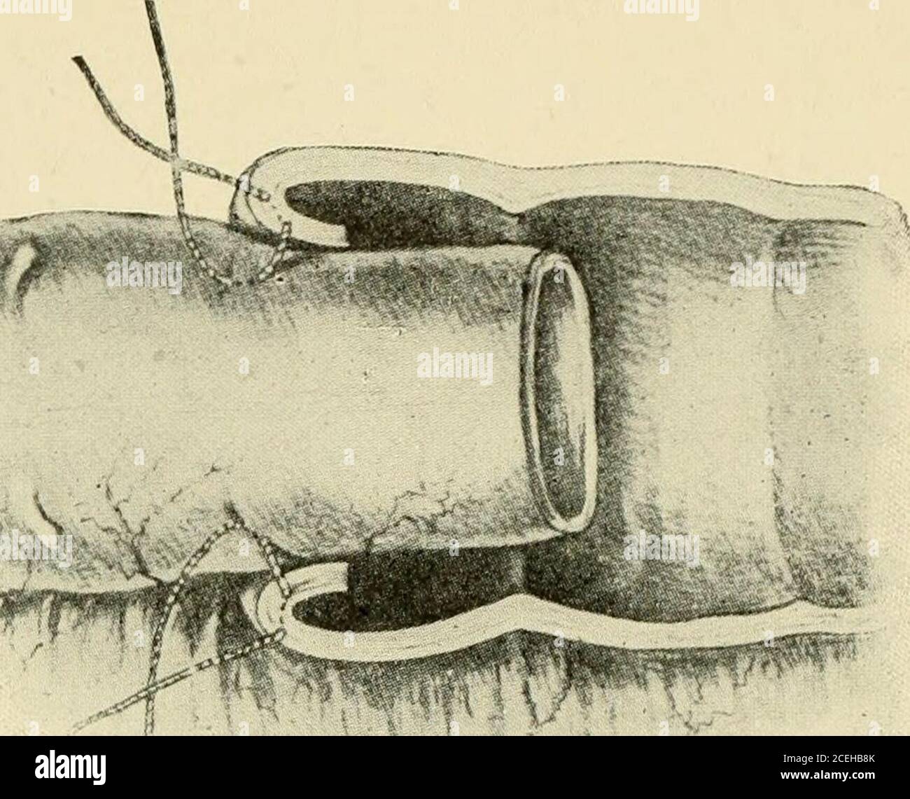 . A new manual of surgery, civil and military. End-to-End Anastomosis ...