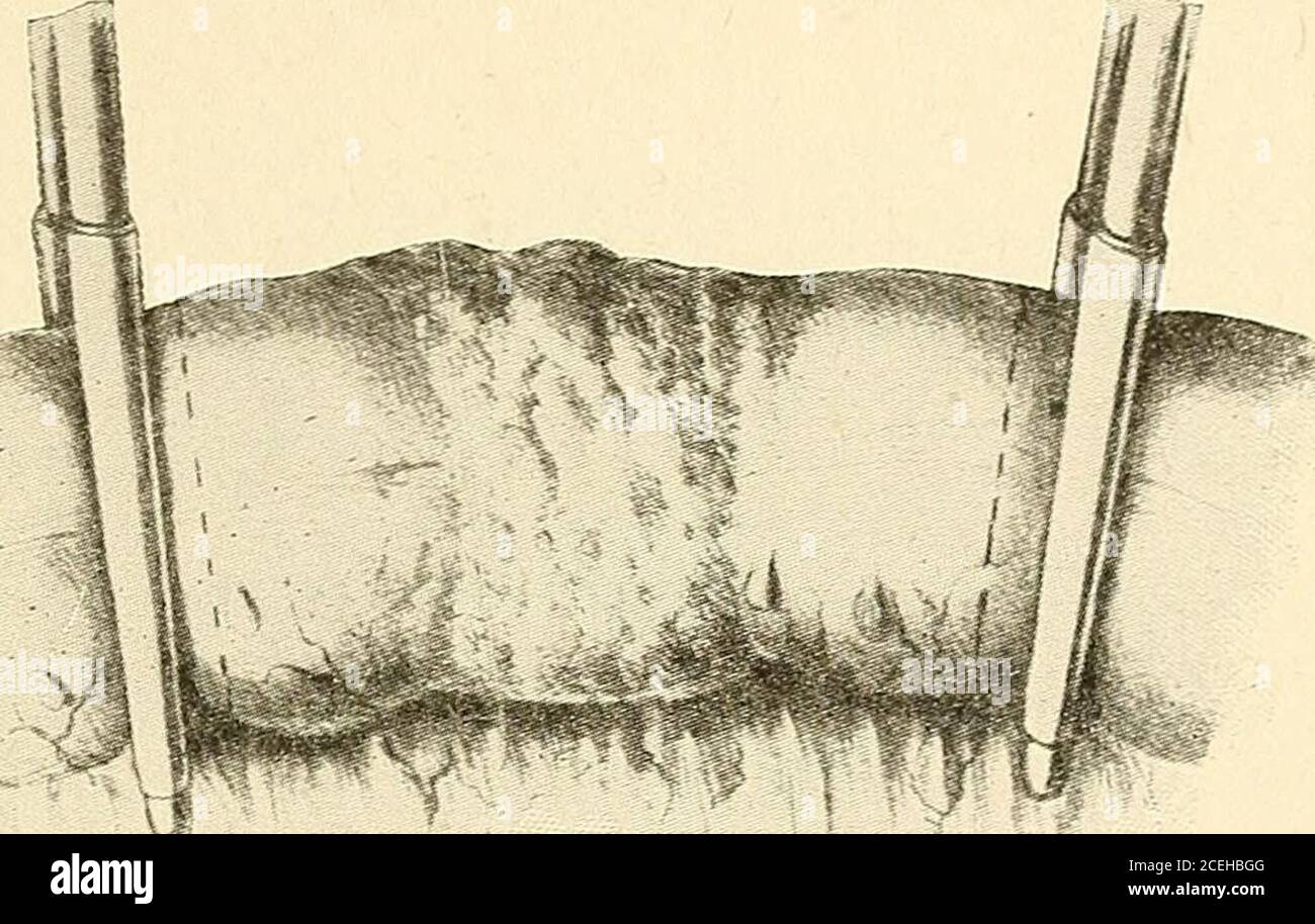 Mcburney incision hi-res stock photography and images - Alamy