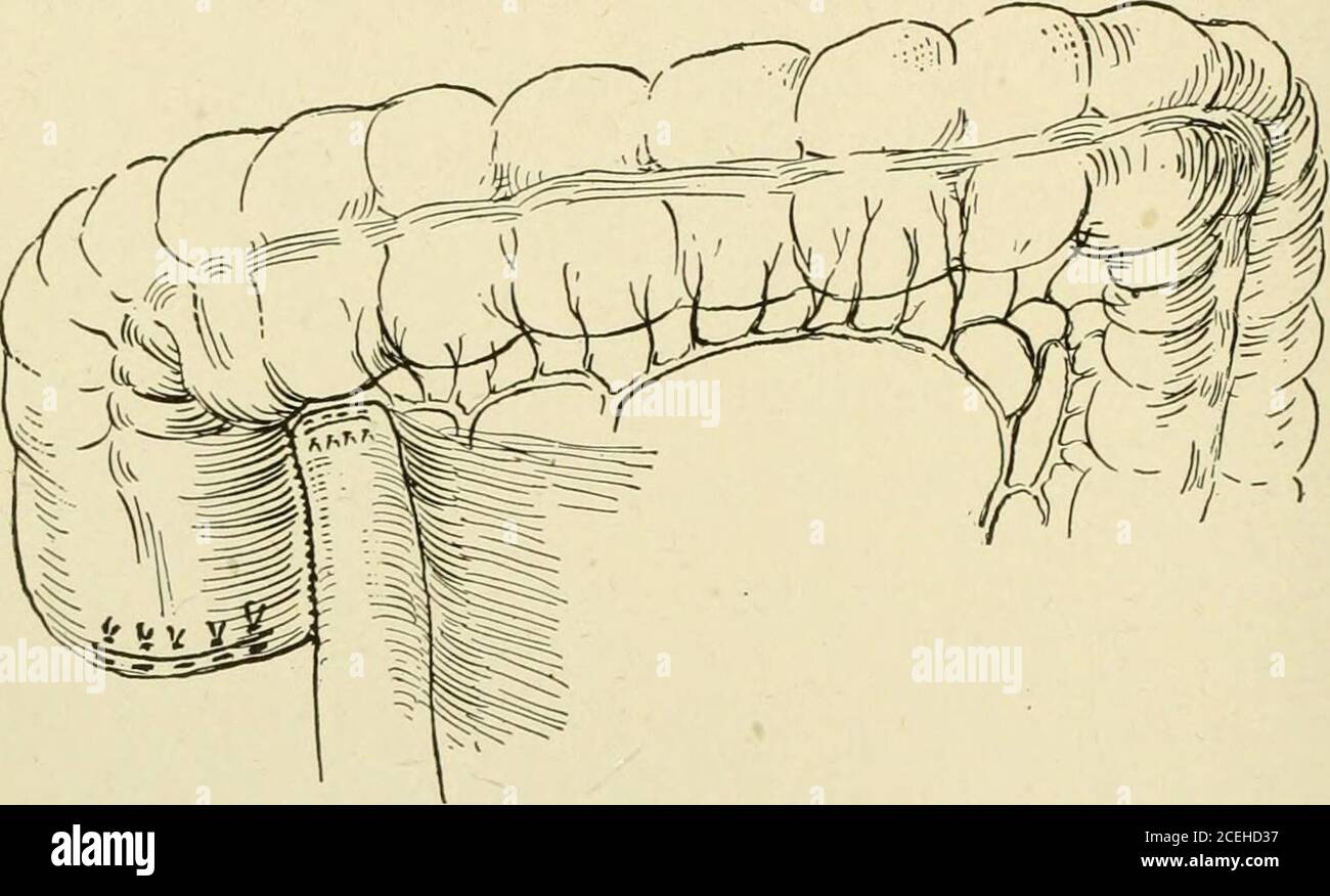 . A new manual of surgery, civil and military. ENERAL SURGERY OF THE ...