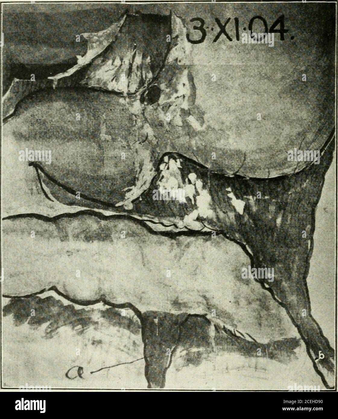 Mikulicz hi-res stock photography and images - Alamy