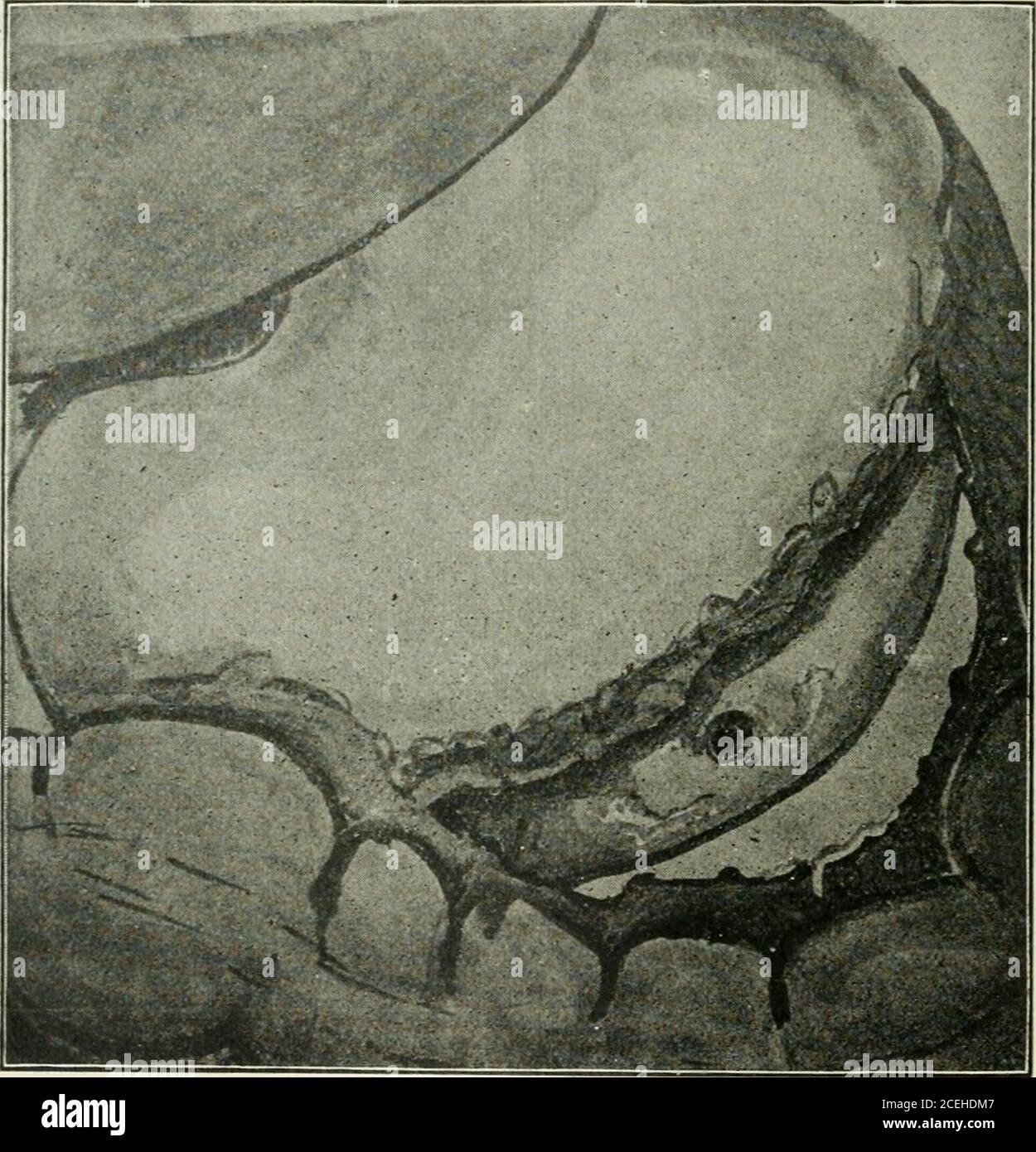 Mikulicz High Resolution Stock Photography and Images - Alamy