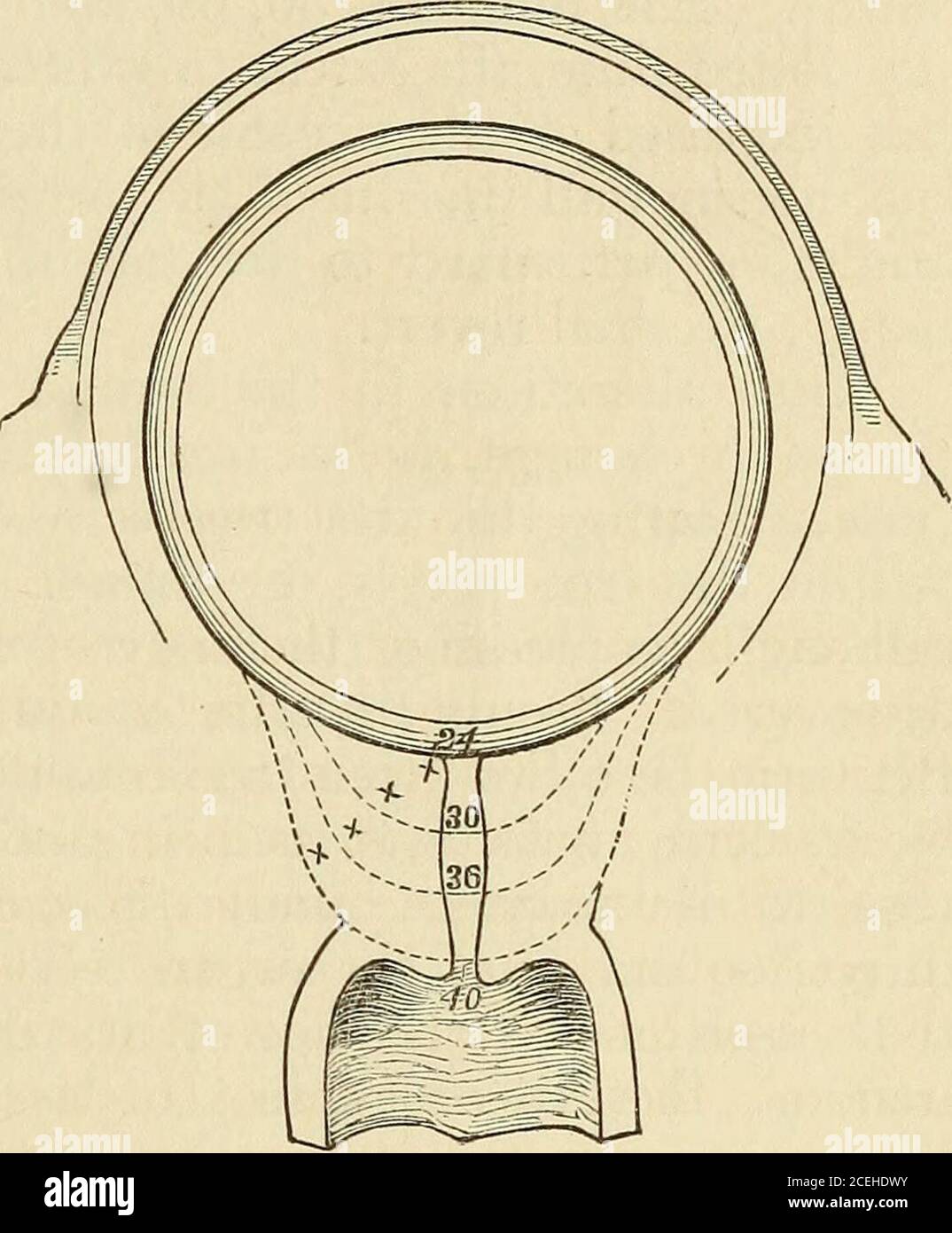 Uterine hypertrophy hi-res stock photography and images - Alamy