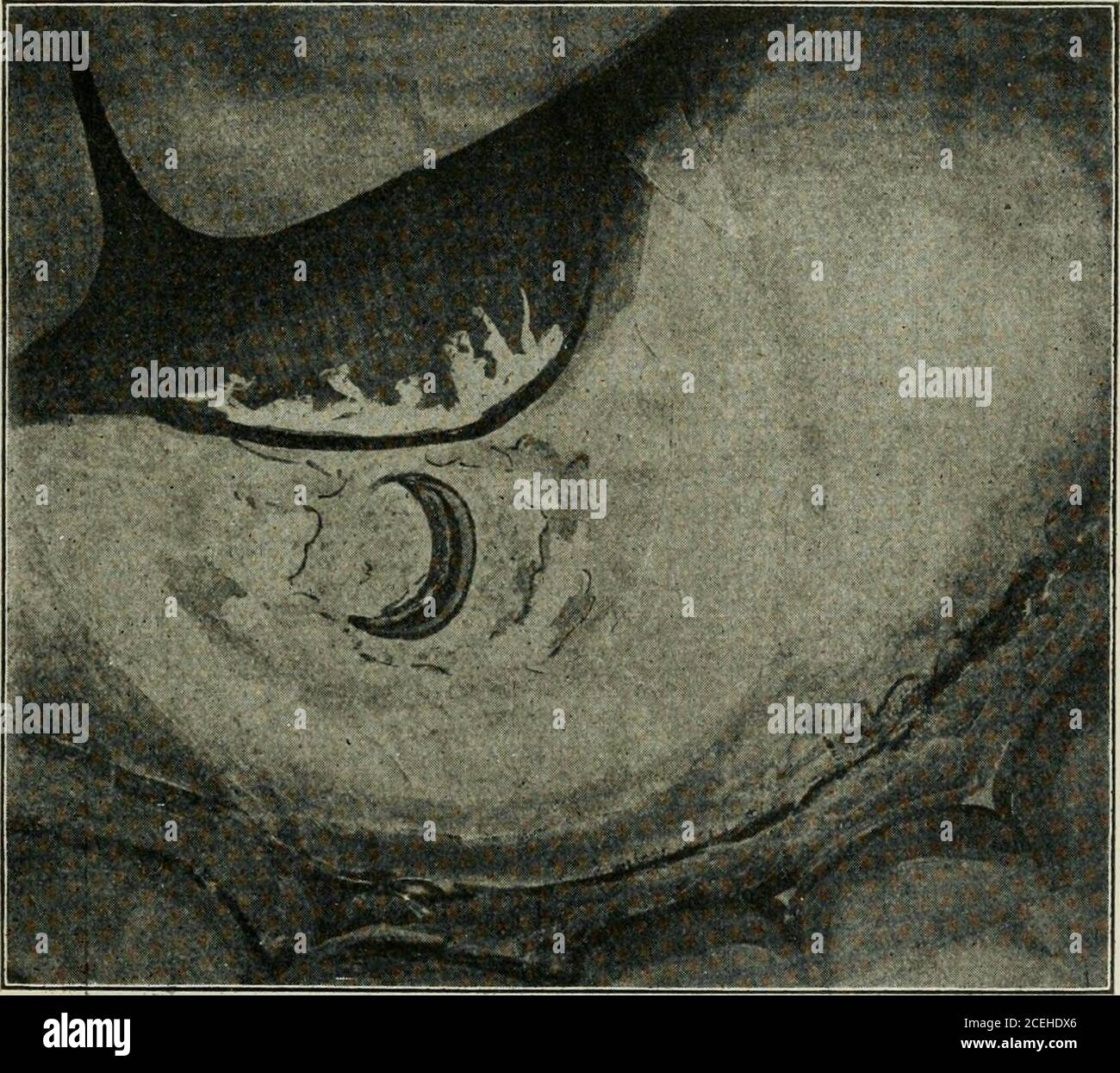 Peritoneal effusion hi-res stock photography and images - Alamy