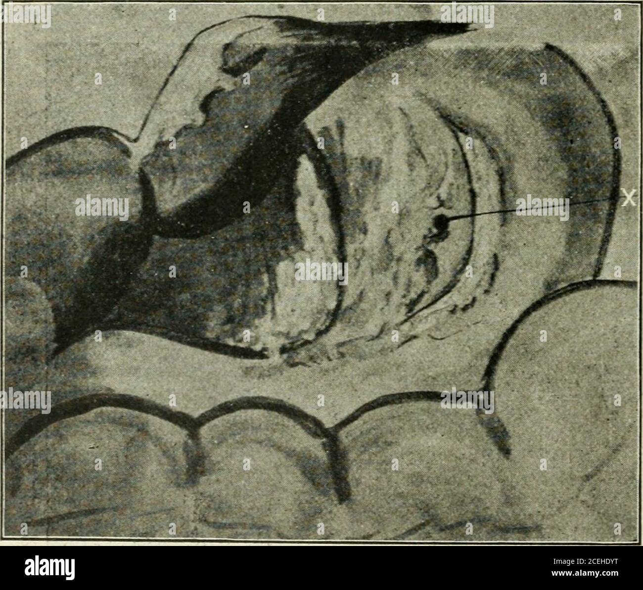 Gastric perforation hi-res stock photography and images - Alamy