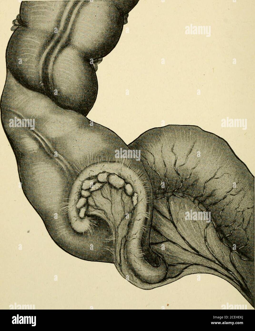 Cecal hi-res stock photography and images - Alamy