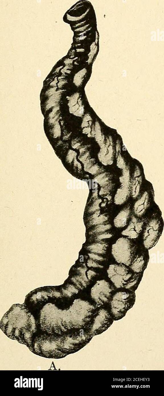 Enterolith hi-res stock photography and images - Alamy