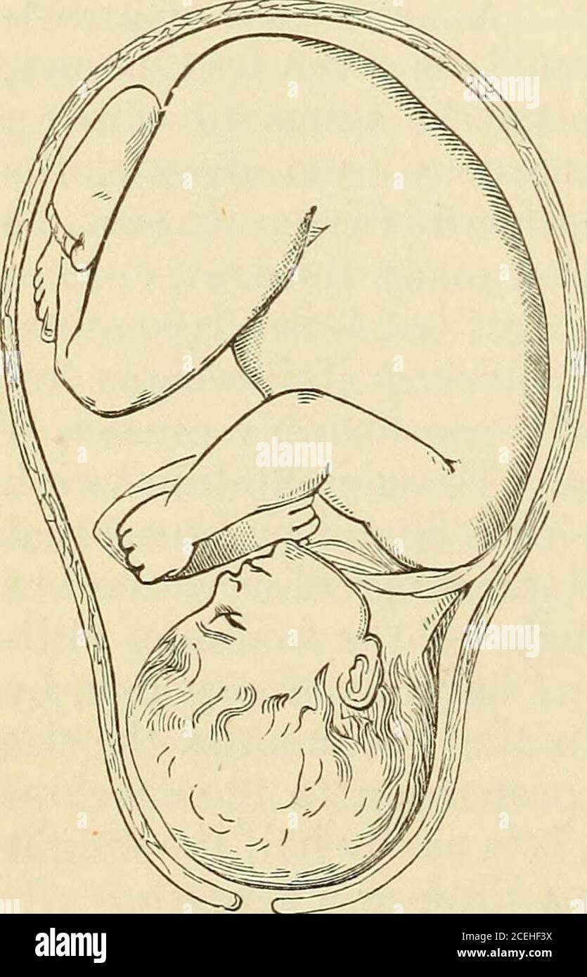 . A system of midwifery, including the diseases of pregnancy and the ...