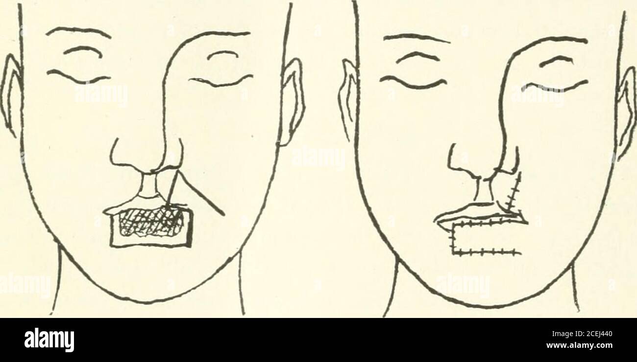 . Annals of surgery. ud-ing the cul-de-sac of the buccal mucous ...