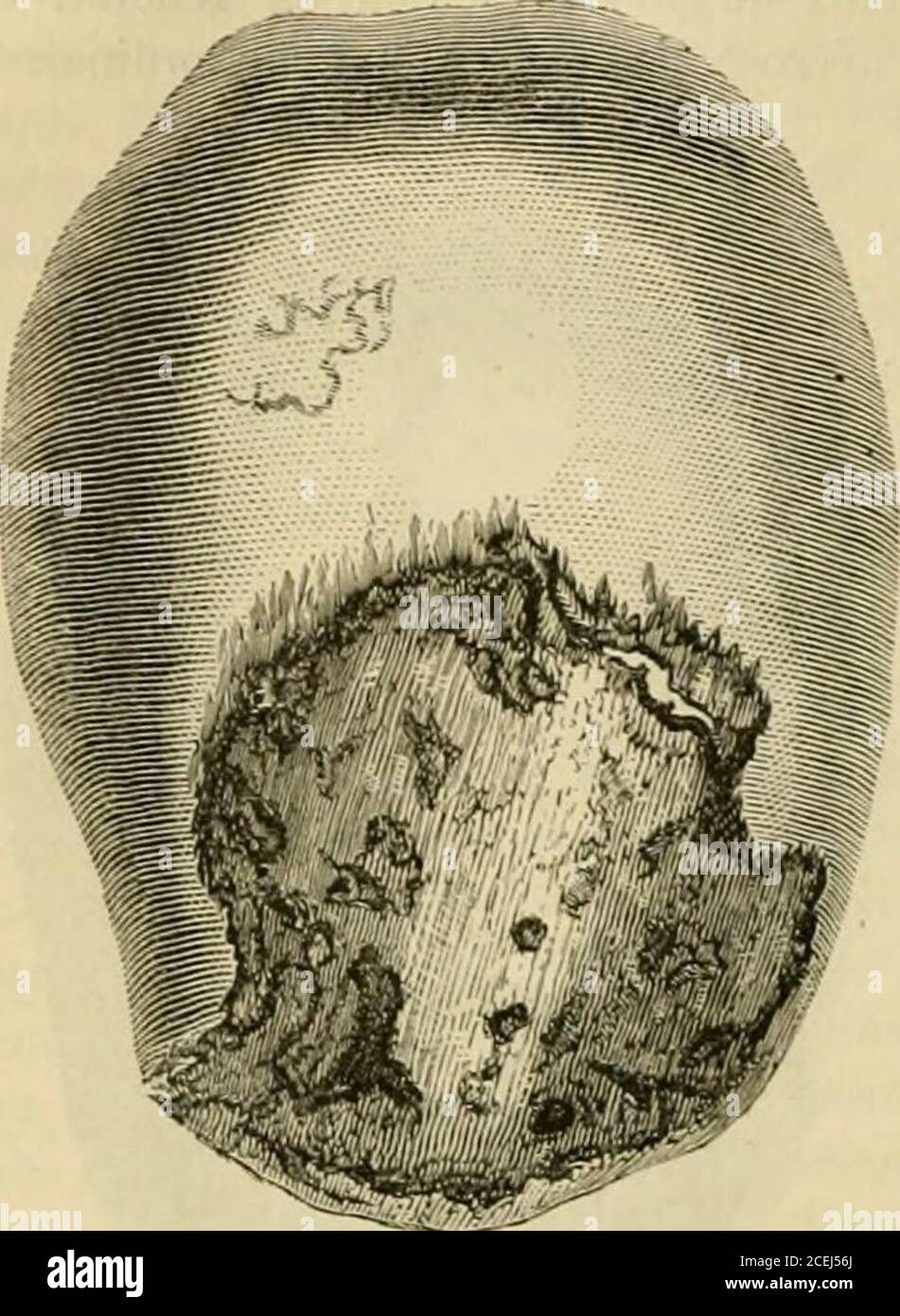 De la syphilis hi-res stock photography and images - Alamy