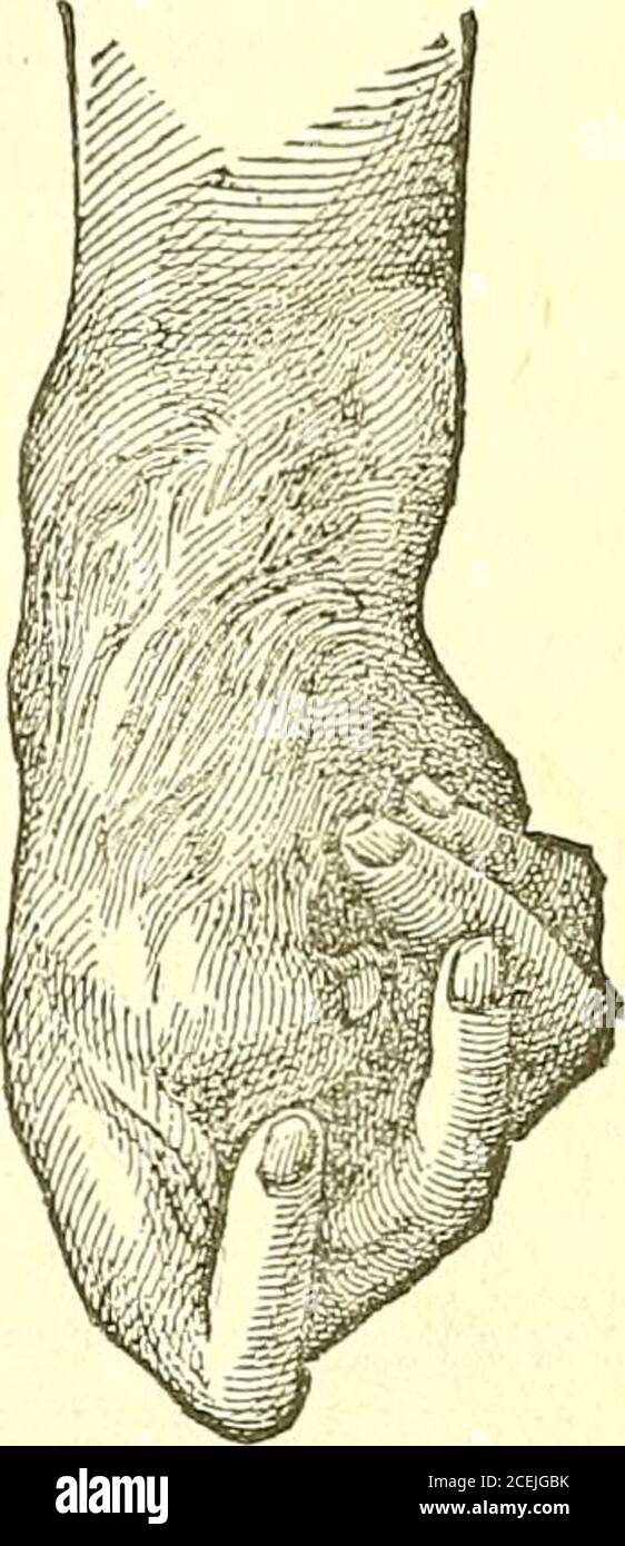 Skin burns wounds hi-res stock photography and images - Alamy